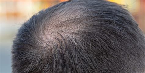 Why Do I Have Bald Spots On My Scalp At Jill Farris Blog