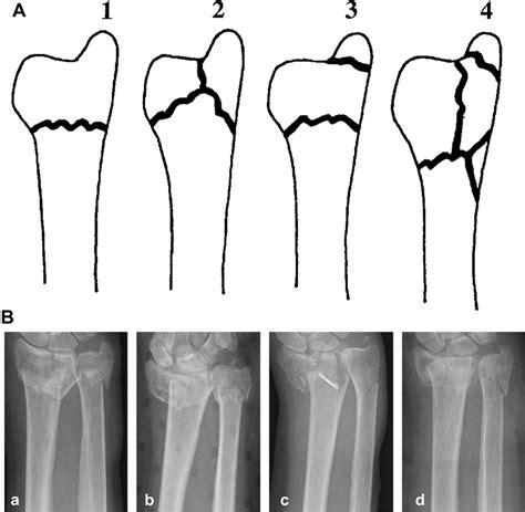 A Fracture Classification Of The Distal Ulna According To Biyani Et Al Download Scientific