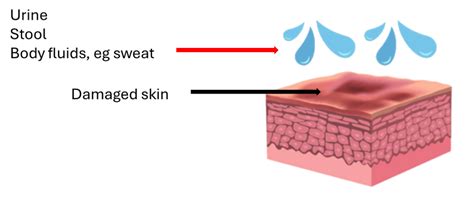 Prevention Pressure Ulcers Bedsores In Bedridden Patients