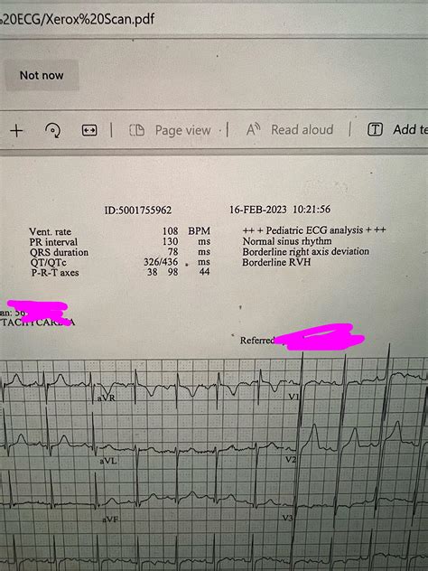 What Does Borderline Ecg Mean On An Ekg