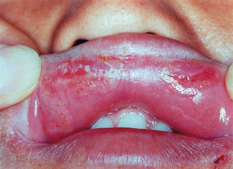 Fungus On Lips Cured In Brazil