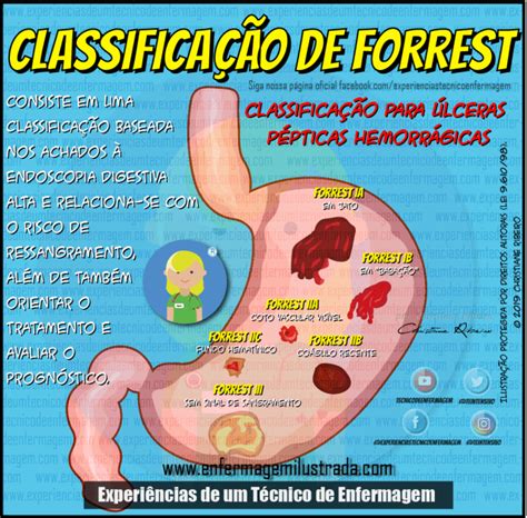 Classificação De Forrest Úlceras Pépticas Hemorrágicas Experiências