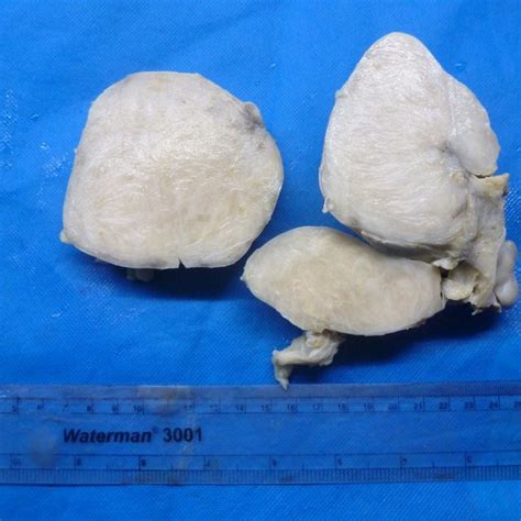 Psammomatous Calcifications Chronic Inflammatory Infiltrate Collagen Download Scientific