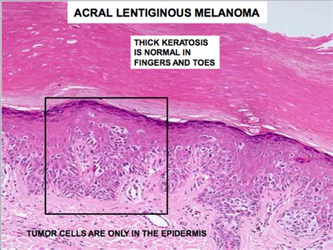 Acral Lentiginous Melanoma Histology