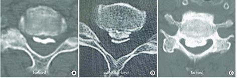 Dural Ossification Associated With Ossification Of The Posterior