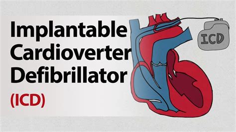 Implantable Cardioverter Defibrillator