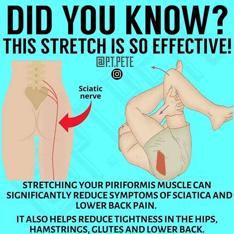 Piriformis Syndrome