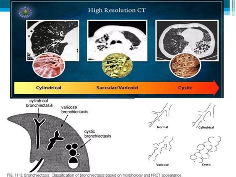 Bronchiectasis Pptx