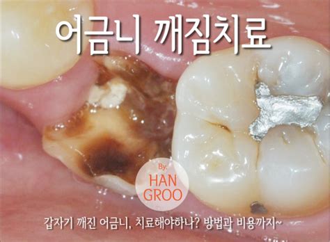 어금니 깨짐 치료받아야 하나 치료비용은 네이버 블로그