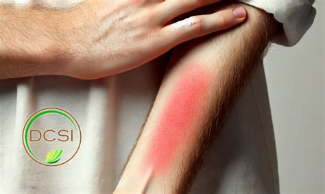 Types Of Rashes And Their Causes Dcsi Dermatology