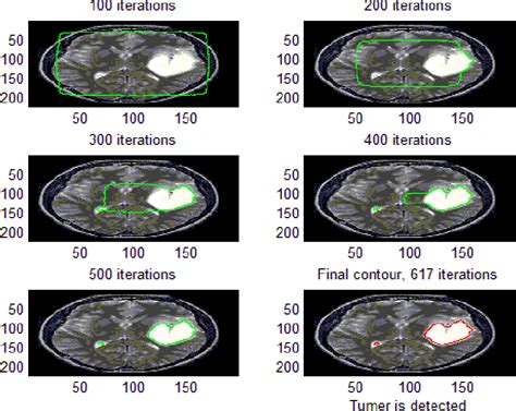 Figure 1 From Mri Image Segmentation Using Level Set Method And Implement An Medical Diagnosis
