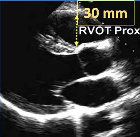 Echo Reference Values Marc Katz MD