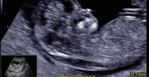 Inverted T Sign In Twin Pregnancy The Lambda Sign Is Also Called The