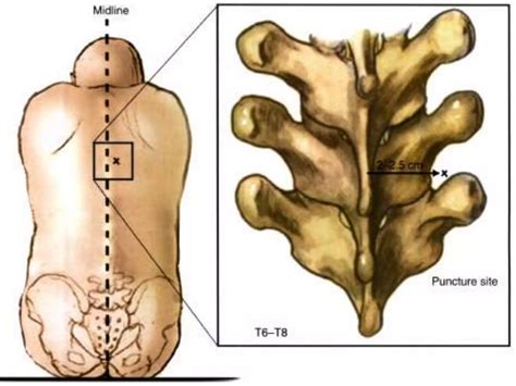 Ultrasound Guided Thoracic Paravertebral Block Pptx
