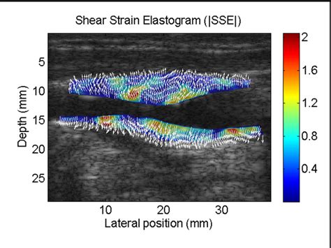 Figure 1 From Carotid Plaque Assessment Using Non Invasive Shear Strain