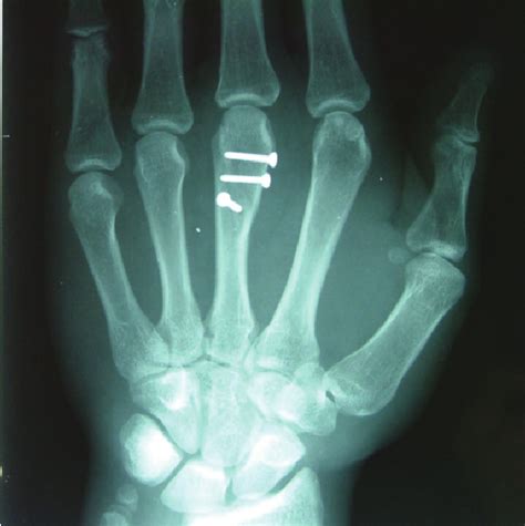 Third Metacarpal Fracture Fixation Surgery Seen On X Ray Download Scientific Diagram