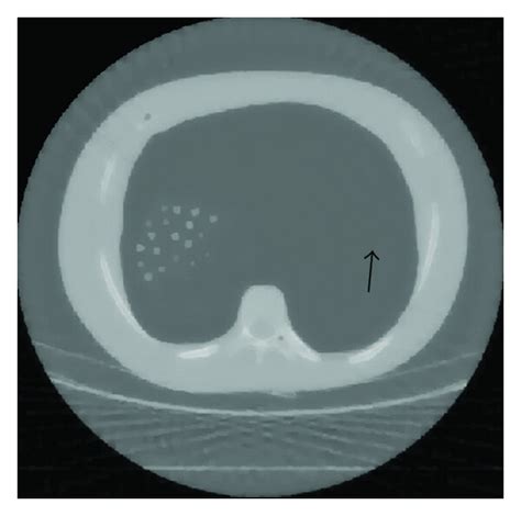 improved compressed sensing‐based algorithm for sparse‐view ct image reconstruction zhu 2013