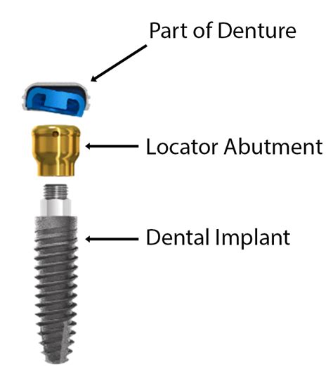 Dentures That Snap Onto Dental Implants Or Implant Retained Denture