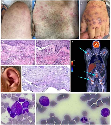 Complex Somatic Mutation Landscape In Myeloid Cells In A Patient With