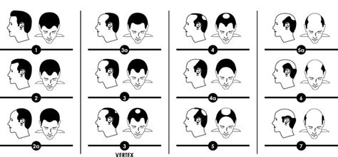 Male Pattern Baldness Causes And Treatments Clinicadvisor®