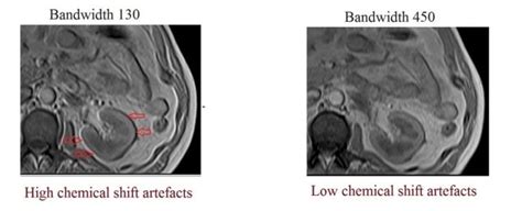 Mri Bandwidth And Image Quality How To Manipulate Transmitter Bandwidth And Receiver Bandwidth