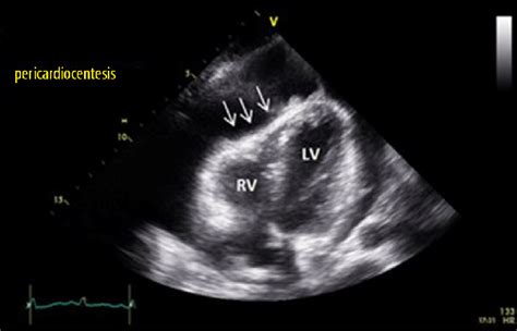 Four Chamber Apical View Of Transthoracic Echocardiogram Showing Early