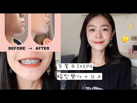 牙套日記EP4牙套兩年的變化側臉變精緻厚厚的下巴不見了 YouTube