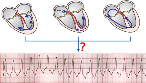 Brugada Algorithm Vt Vs Aberrant Svt Ecg Book