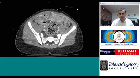 Pancreatic Laceration Ct Scan Video By Dr Arjun Kalyanpur Youtube