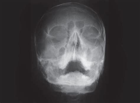 Ectopic Tooth In The Anterior Wall Of Maxillary Sinus International Journal Of Recent Surgical