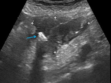 What Is Hepatic Flexure Syndrome At Whitney Luke Blog