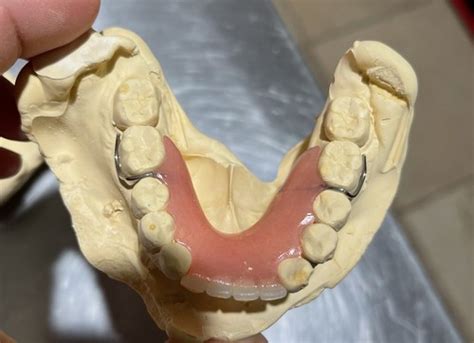 Custom Missing Teeth Flipper Stayplate For Upper Lower Hard Acrylic
