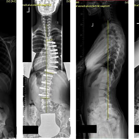 The Four Types Of The Roussouly Sagittal Classification The Shape Of