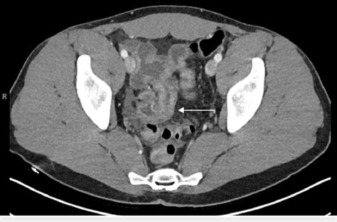 Preoperative Computerized Tomography Imaging Demonstrating Severe