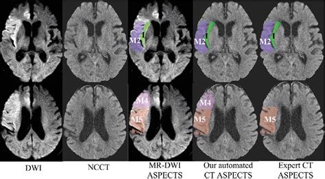 Figure 4 From Automated Aspects On Noncontrast Ct Scans In Patients With Acute Ischemic Stroke