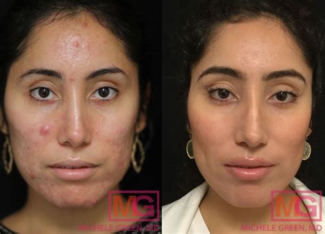 Accutane Before And After Cystic Acne