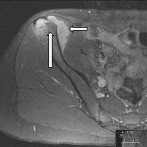 Axial Post Intravenous Gadolinium T1 Fat Saturated Image The Haematoma