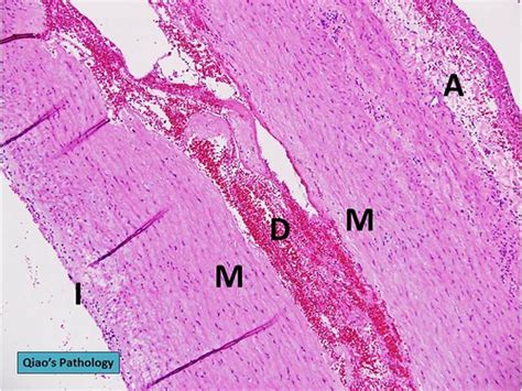 Qiaos Pathology Aortic Dissection Microscopic Photo Show Flickr