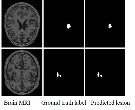 examples of lesion prediction by our proposed segmentation model the