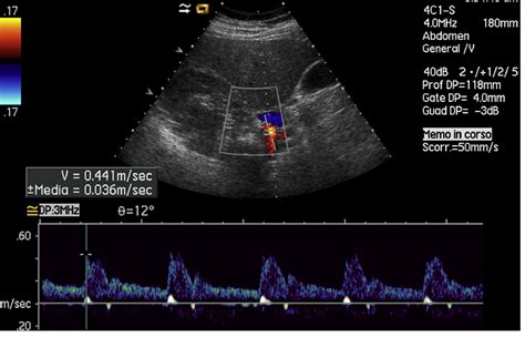 Table 1 From Doppler Ultrasound And Renal Artery Stenosis An Overview