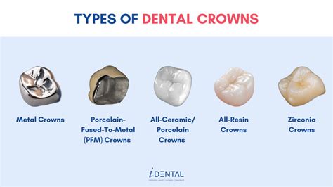 Dental Crowns Types