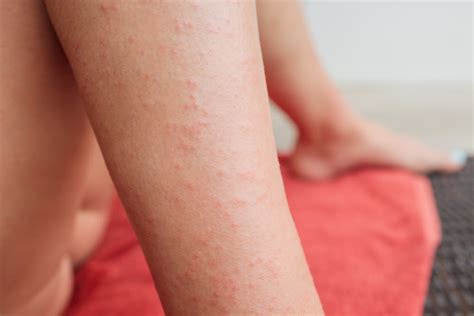 Gluten Rash Face