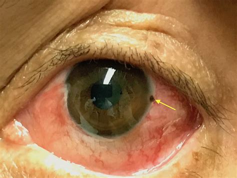 Corneal Rust Ring Jetem