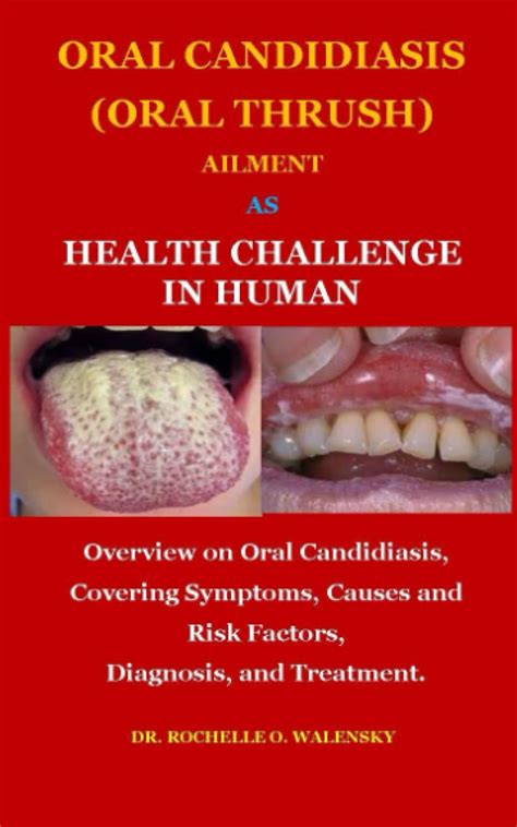 Buy Oral Candidiasis Oral Thrush Ailment As Challenge In Human