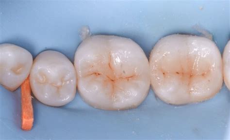 Class Ii Adjacent Cavities On 1st And 2nd Molars Quickmatfit