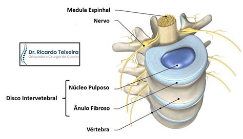 Hérnia De Disco Lombar Dr Ricardo Teixeira