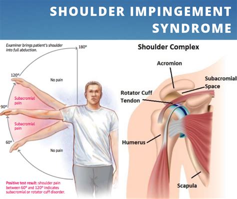 Shoulder Impingement Syndrome Is The Osteopathic Clinic Facebook