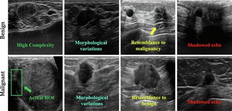 Optimizing Proportional Balance Between Supervised And Unsupervised Features For Ultrasound