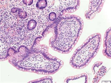 Ileitis Humpathcom Human Pathology