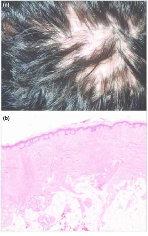 Pseudopelade Of Brocq A Characteristic Noninflamed Irregular Patch